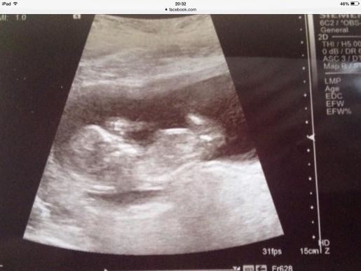 Miscarriage rateafter 12 week scan?