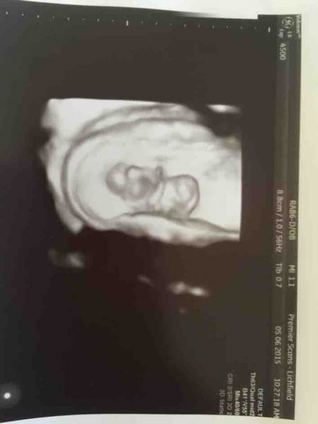 10 week scan pics.