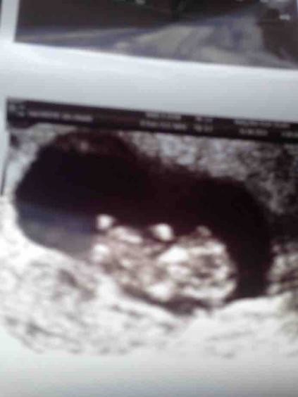 10 Week Scan Pics?