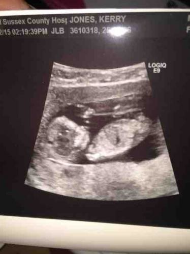 12 week scan ! Worried
