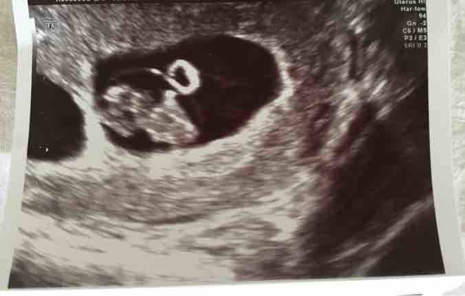 Has anyone had an early scan?