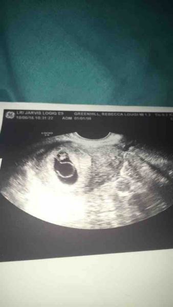 7 week scan tomorrow at EPAU