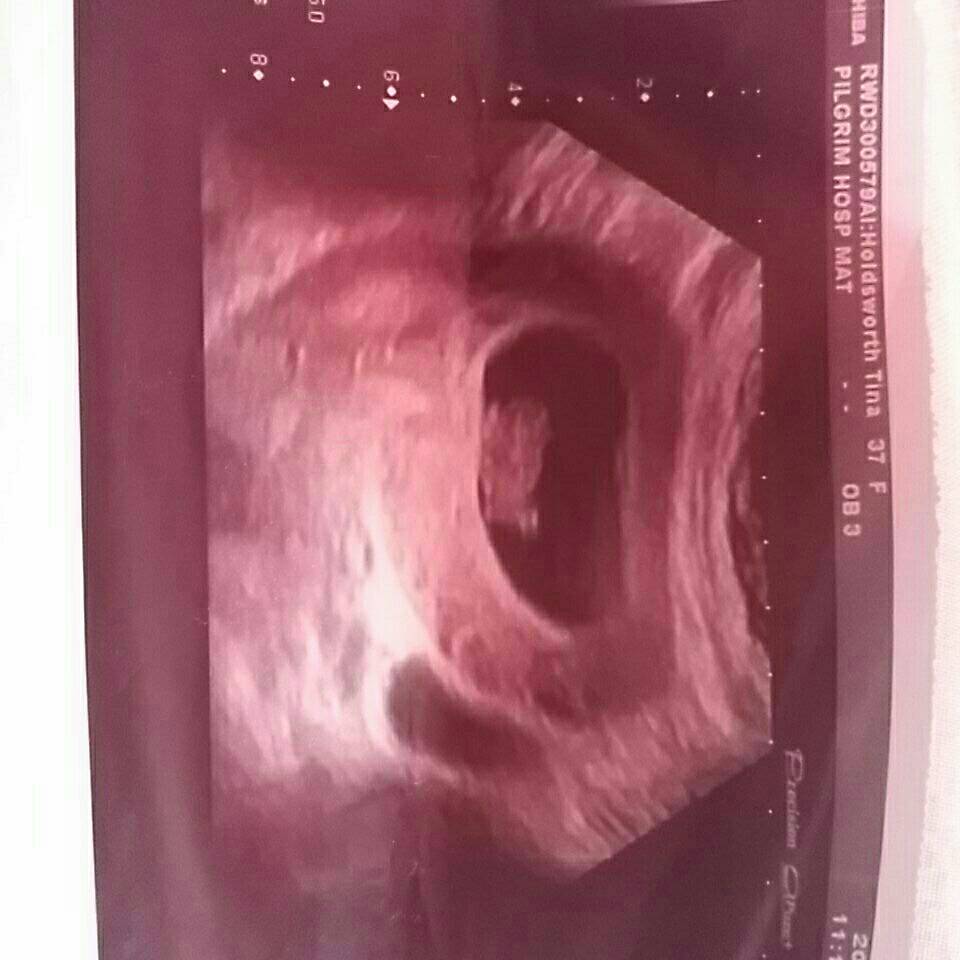 Anyone else got an 8 week scan to compare?