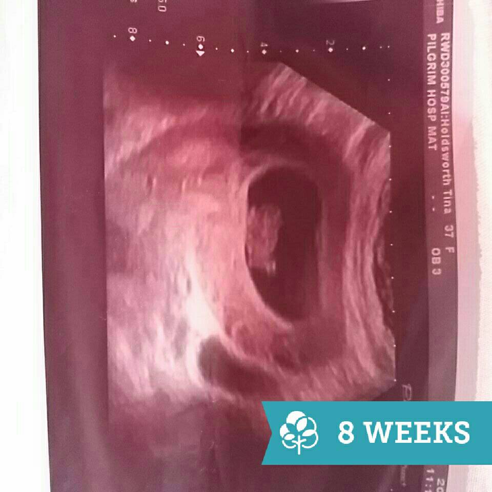 Anyone else got an 8 week scan to compare?