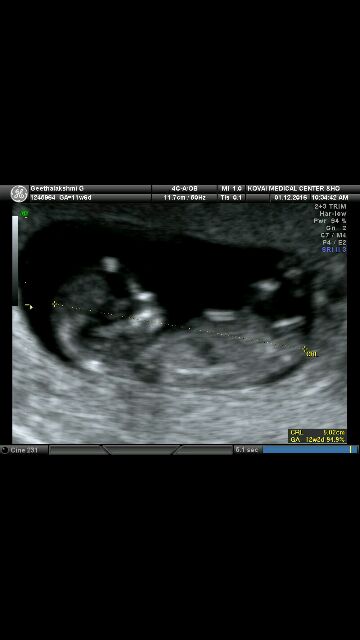 Scan at 7 weeks showing as 5