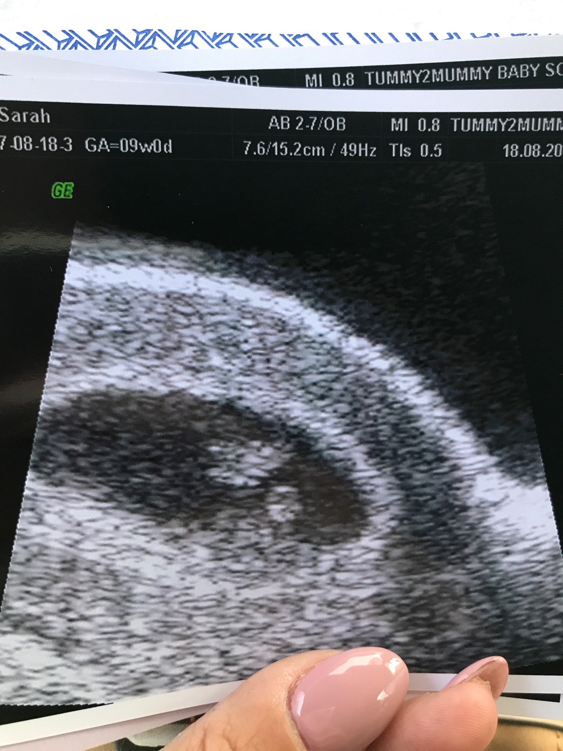 9 week scan