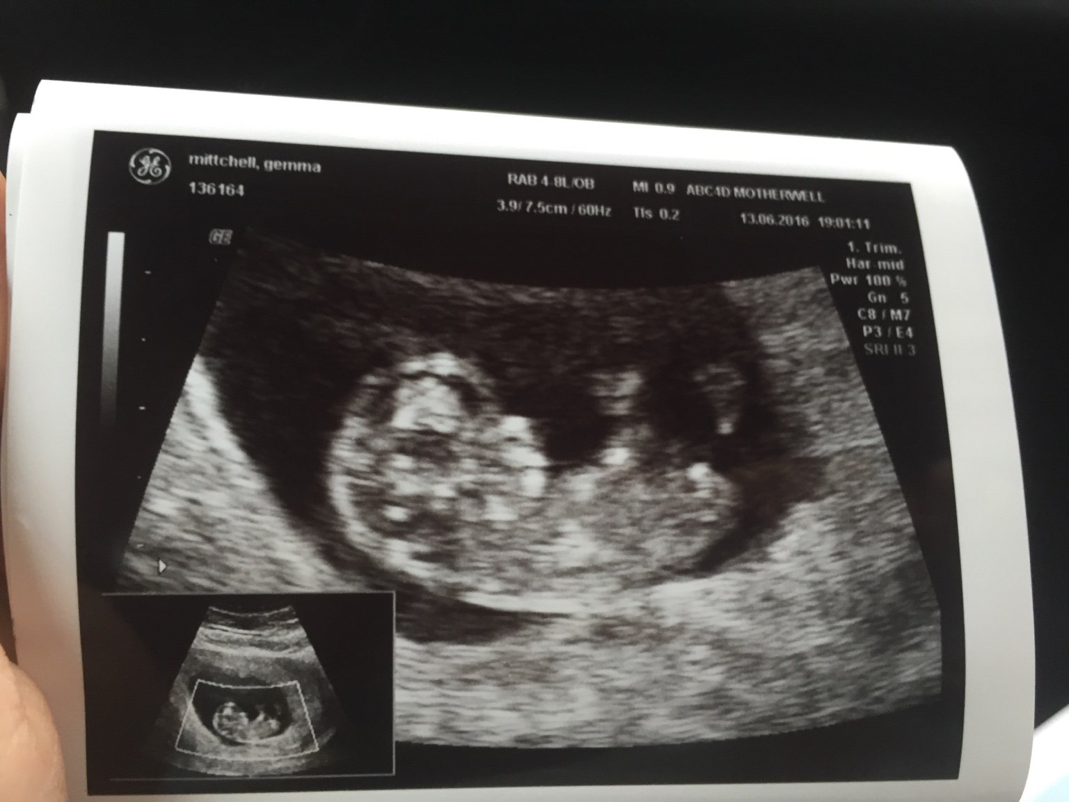 9 week scan