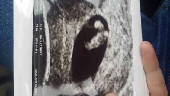 Scan at 7 weeks 4 days