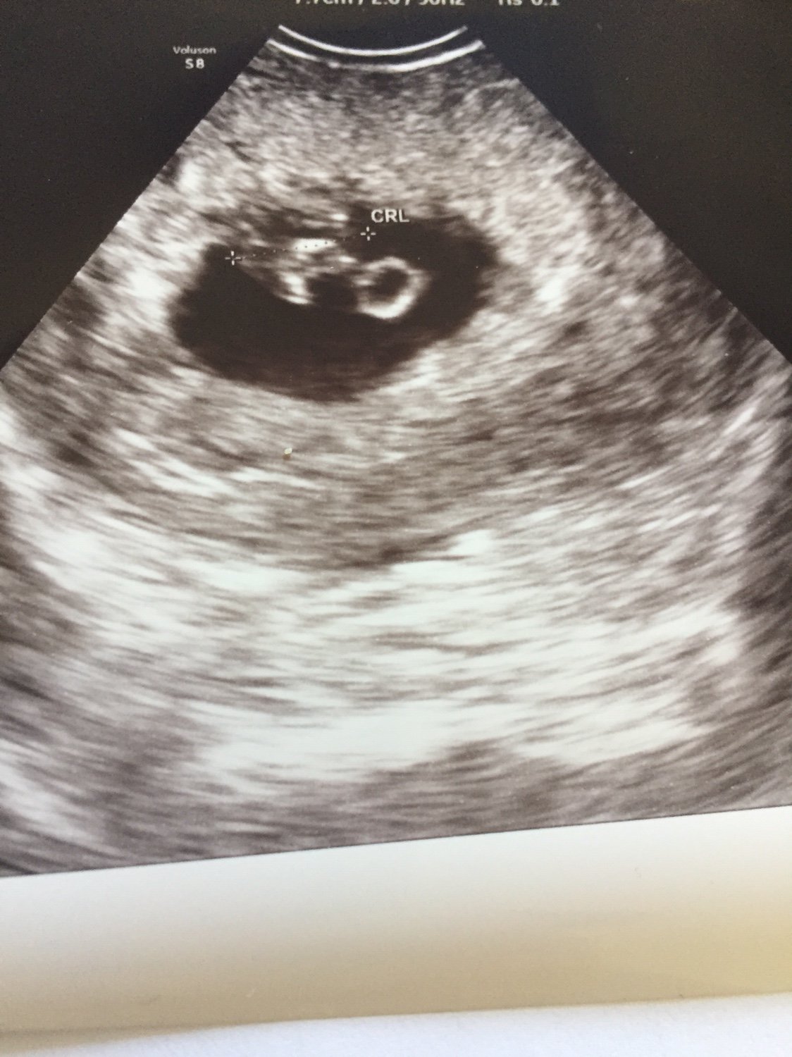 6 weeks exactly, early scan, yolk sac only - Page: 2