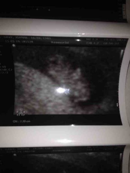 9 week scan pic