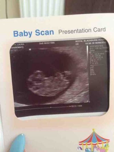 9 week scan pic