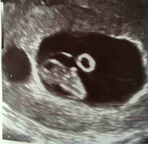 8 week scans