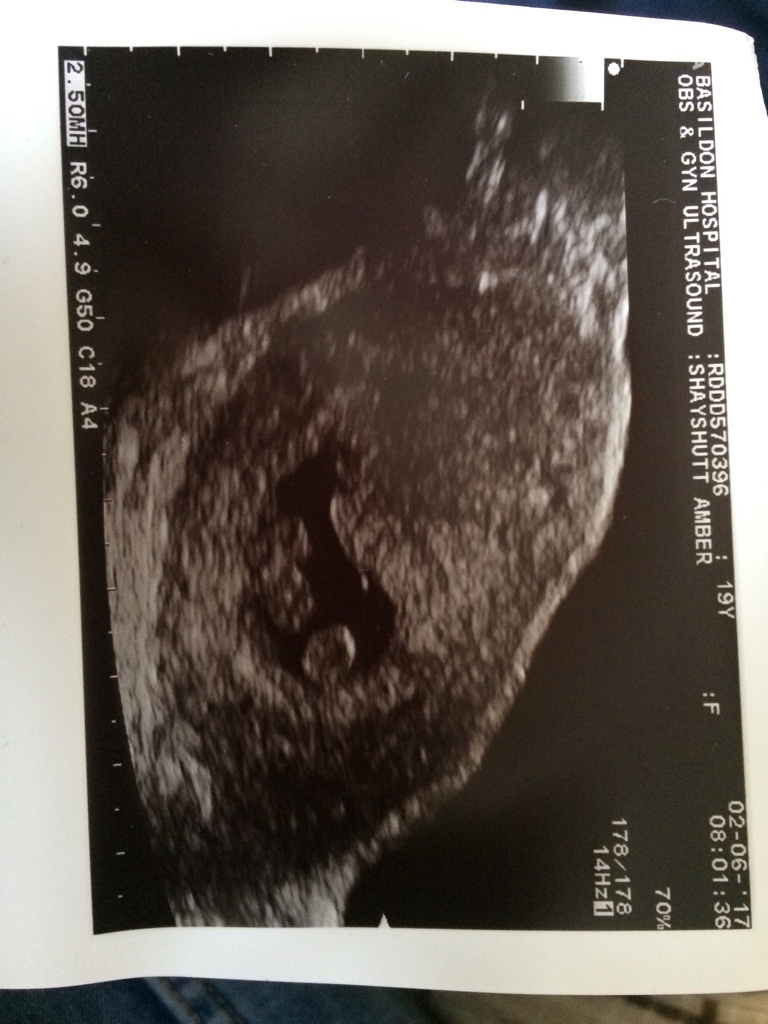 8 week reassurance scan