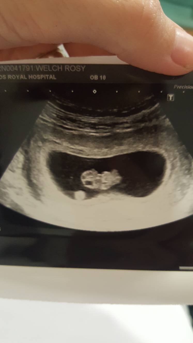 Early scan @ 8 weeks