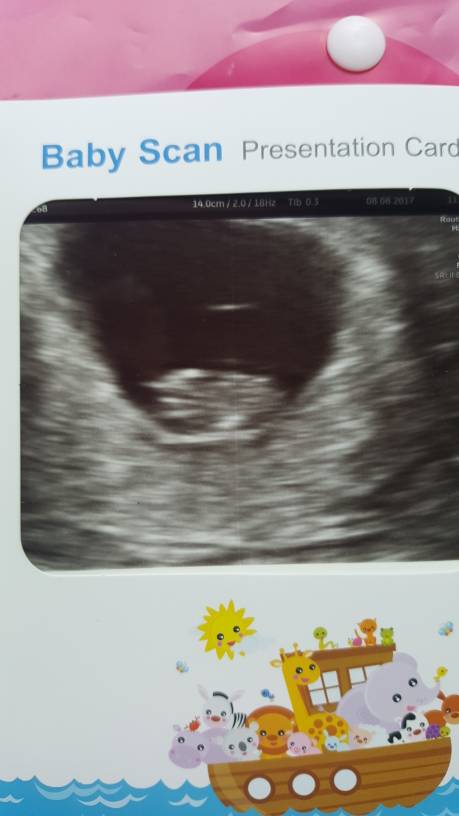 Early scan @ 8 weeks
