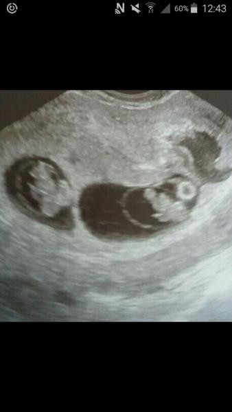 Early scan @ 8 weeks