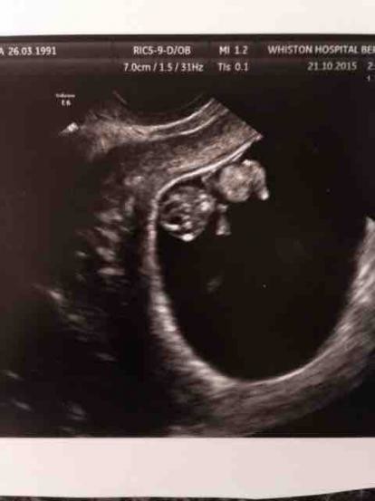 What's the earliest you can see a baby on a scan? - Page: 2