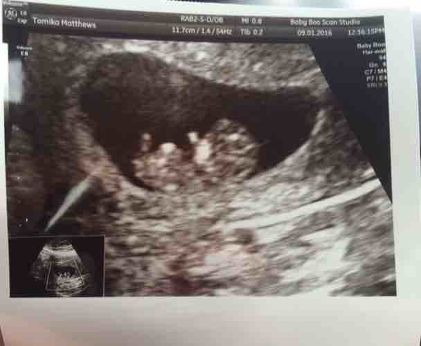 Scan at 9 weeks?