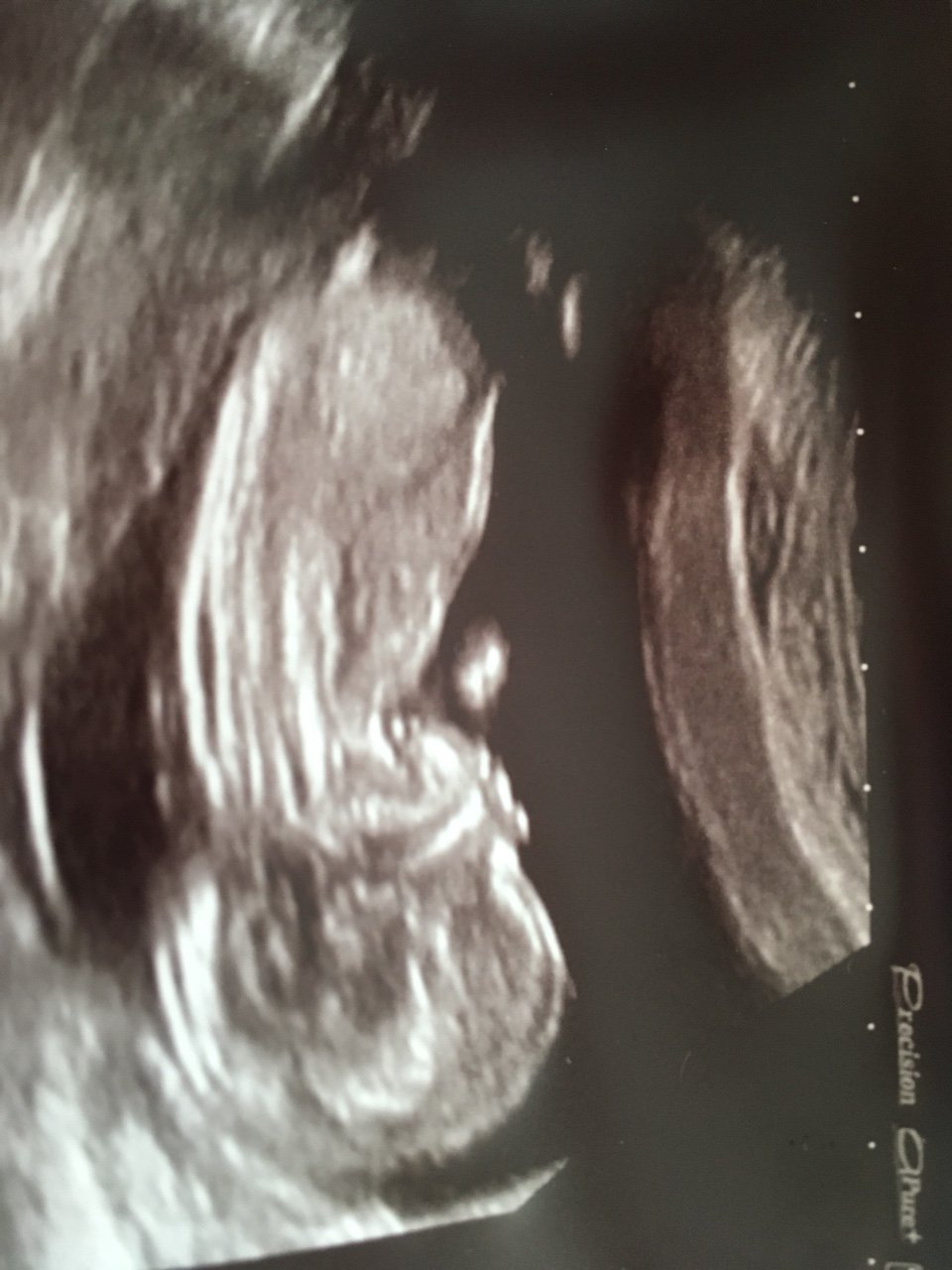 Gender guess by nub at 12 week scan