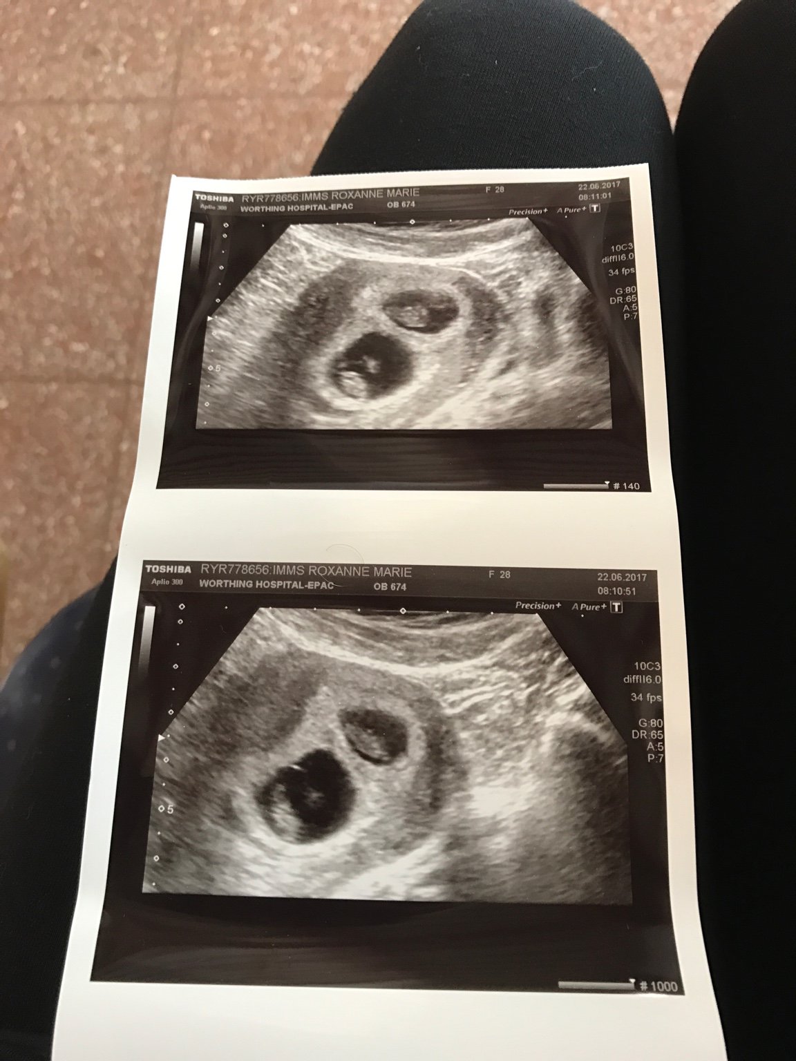 early scan is it twins ??? - Page: 2