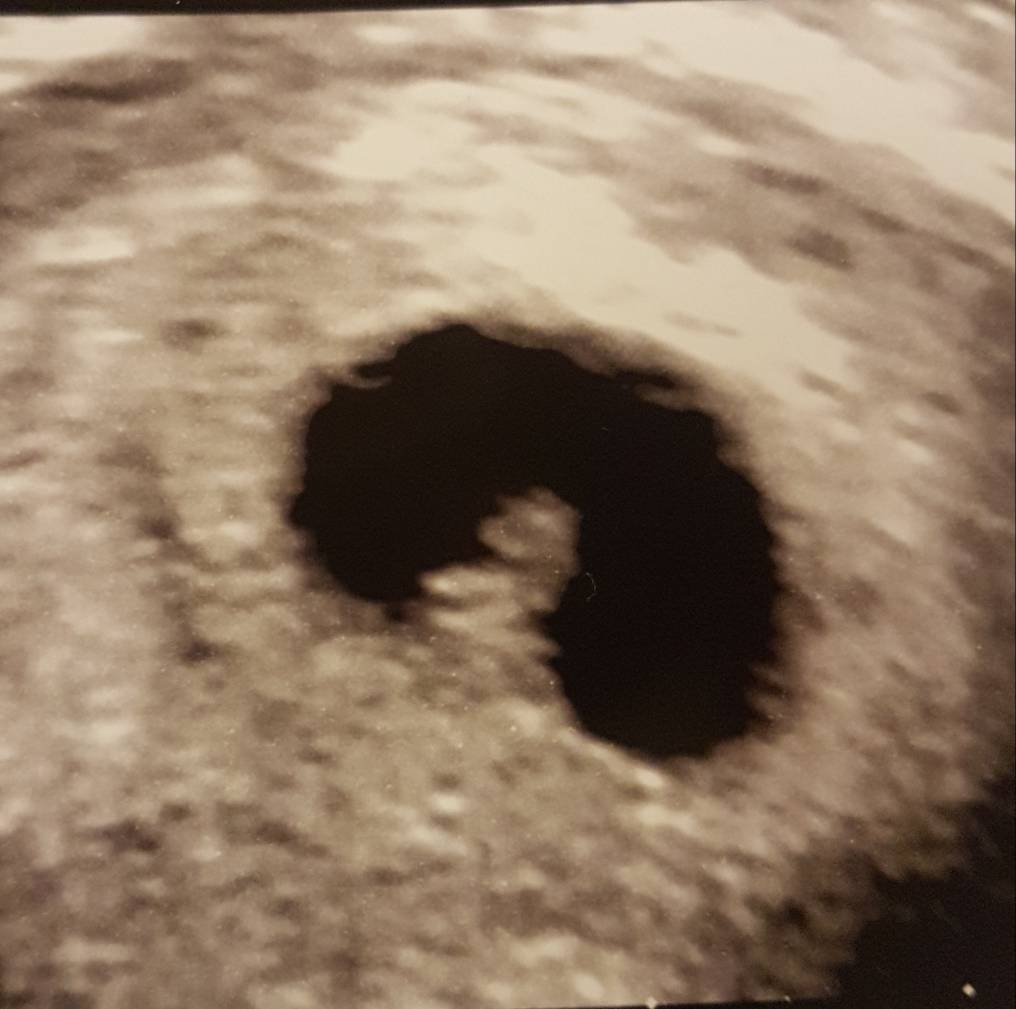 Pain and a 5 week scan - Page: 2