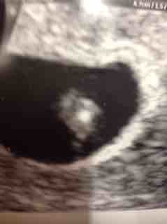 Early scan at 6 weeks