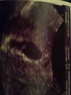 Early scan at 6 weeks