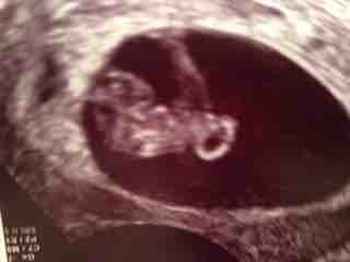 Early scan at 6 weeks