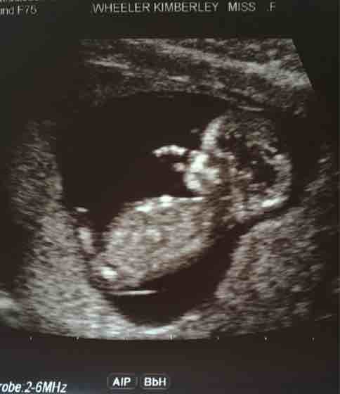 Gender guesses from 12 week scan