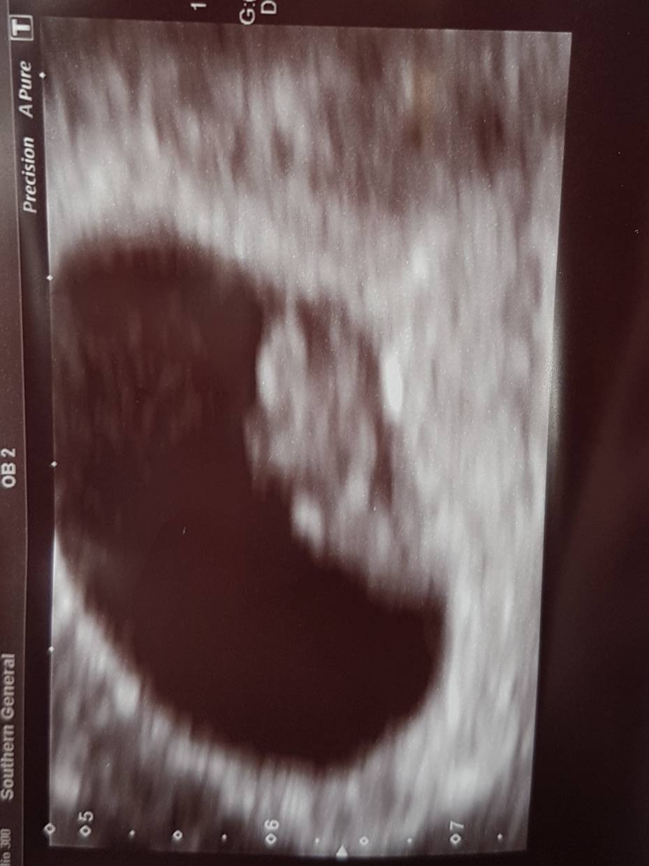 7 week scan