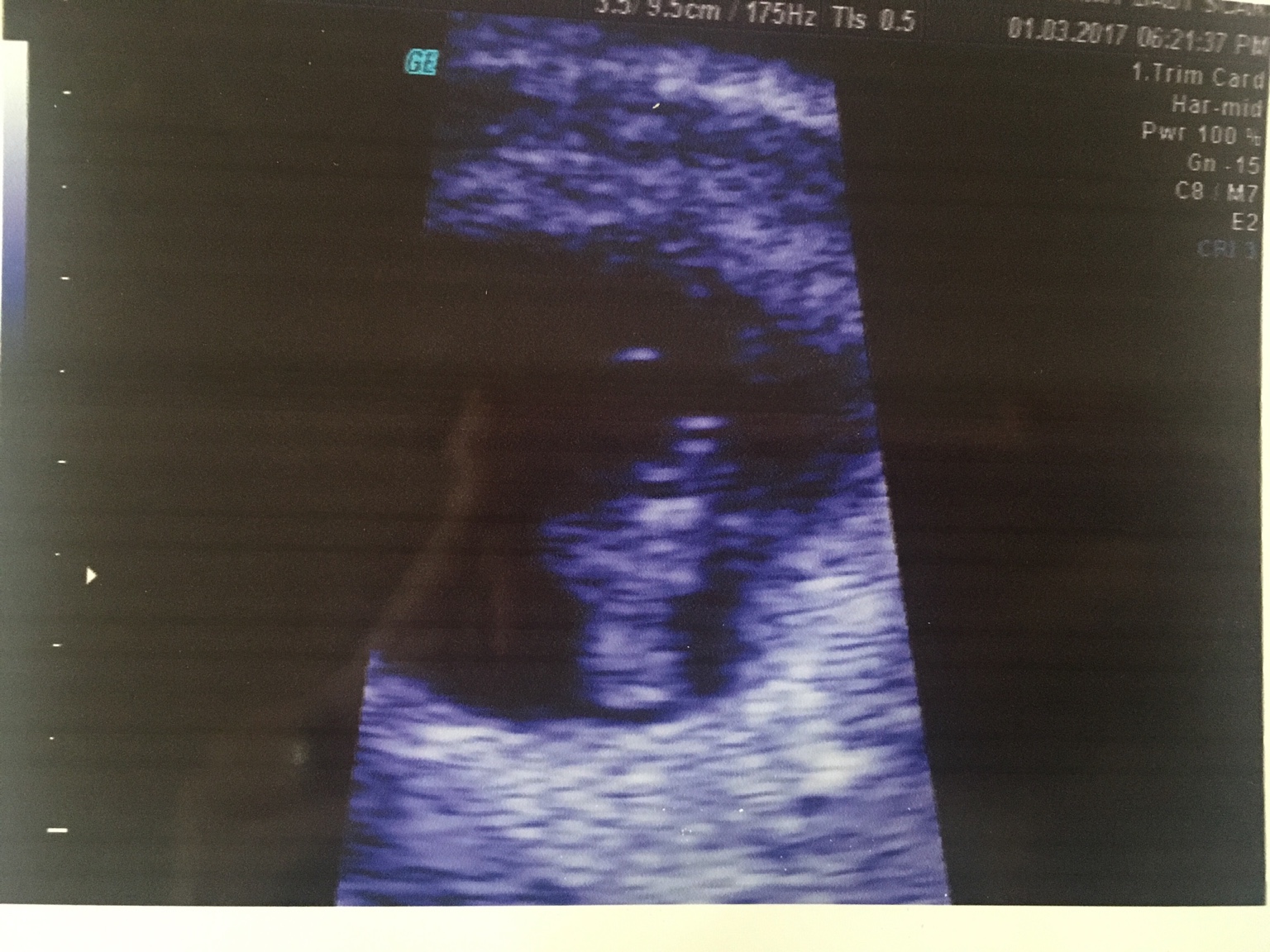 7 week scan