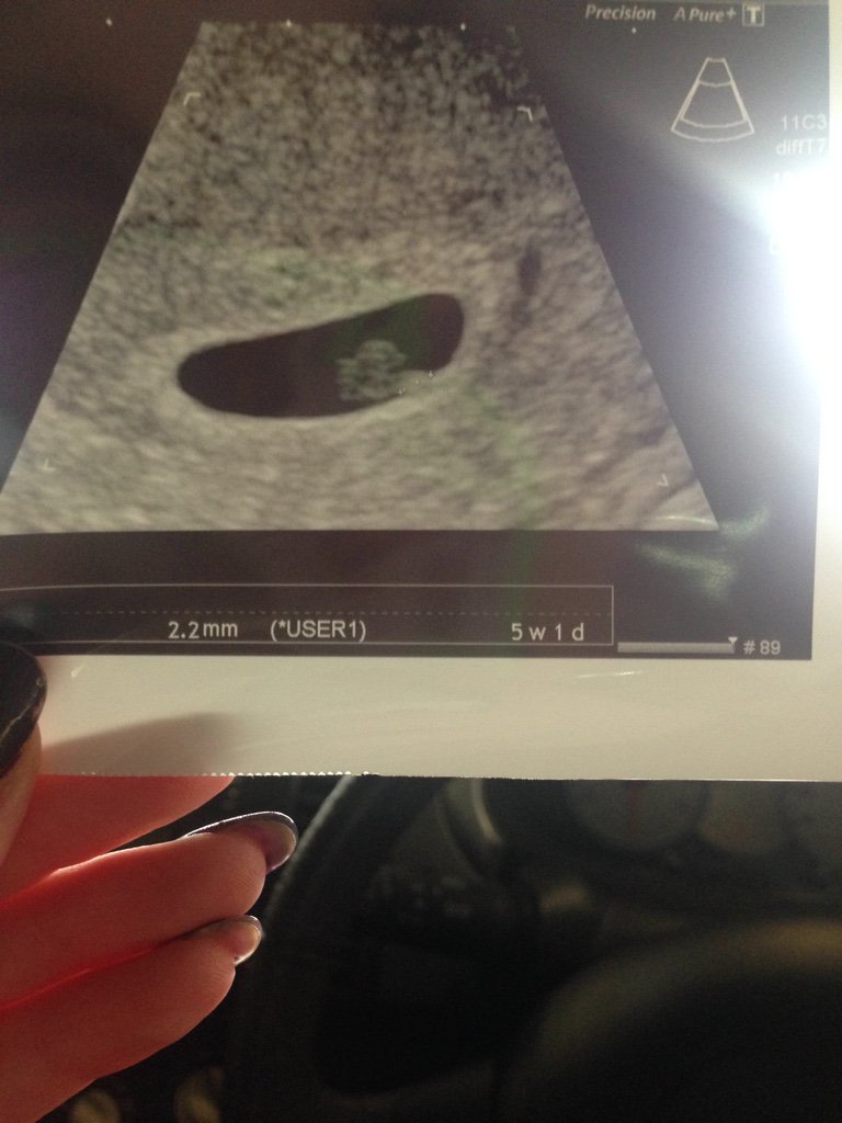 Early scan 6weeks + 1 day