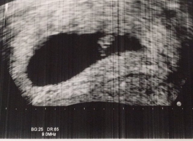 Early scan 6weeks + 1 day