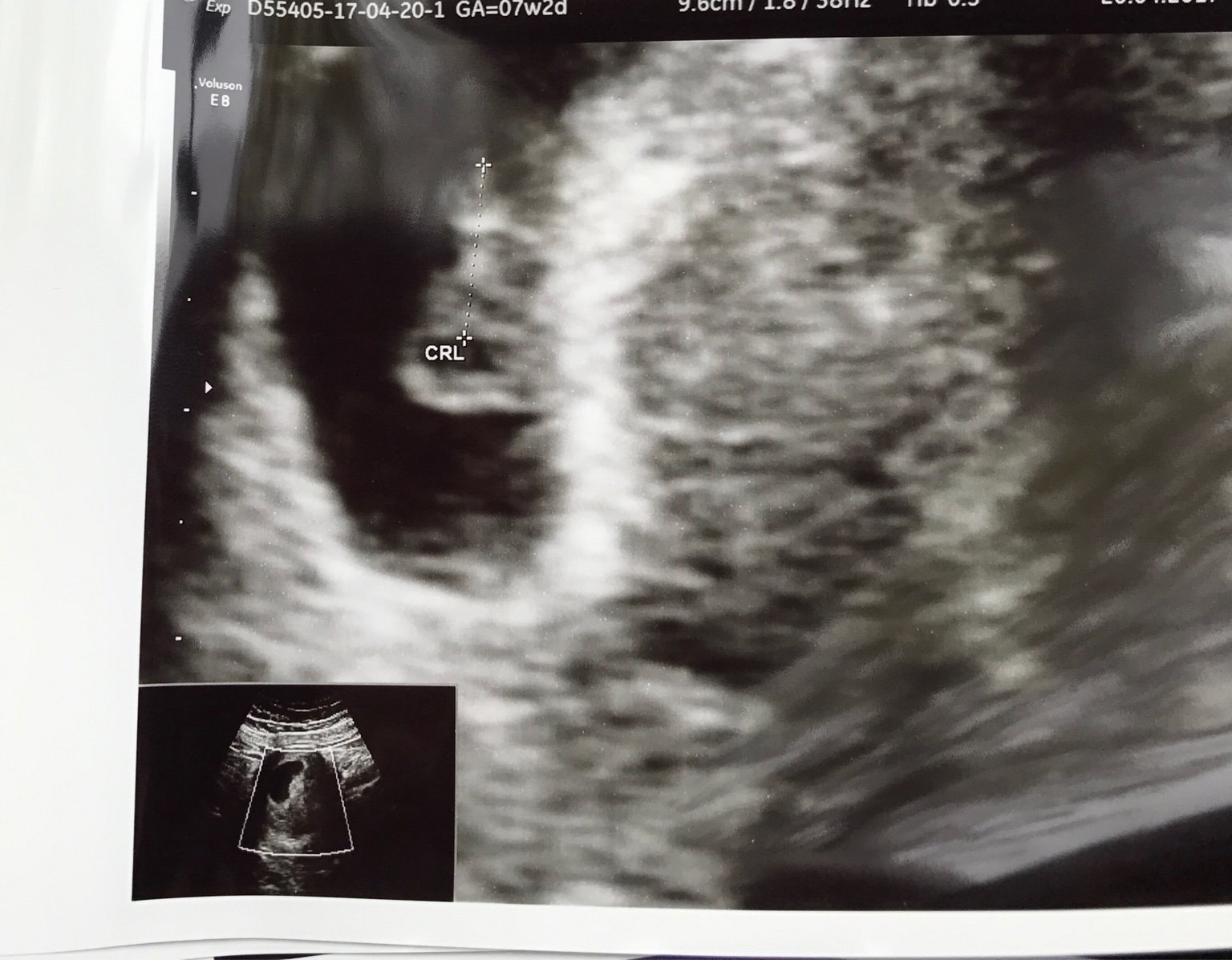 pictures of early scan photos