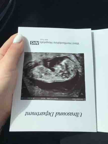 Nhs early scan