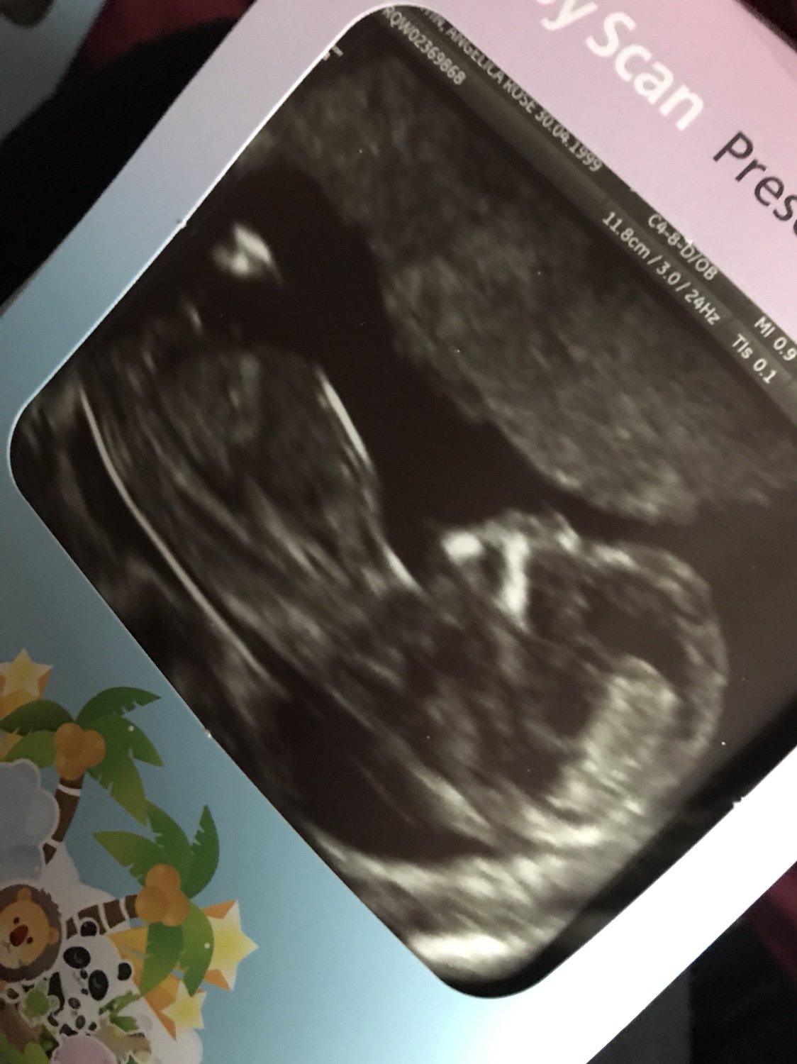 Gender scan at 16 weeks