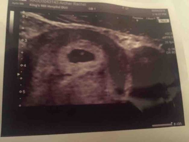 Can people post there 6 weeks scan