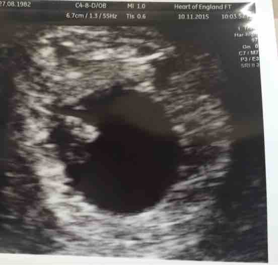 Can people post there 6 weeks scan