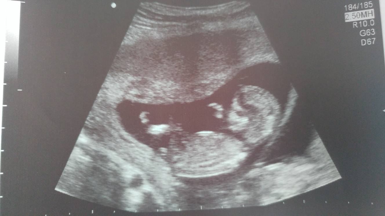 My 12 week scan on Monday... - Page: 2