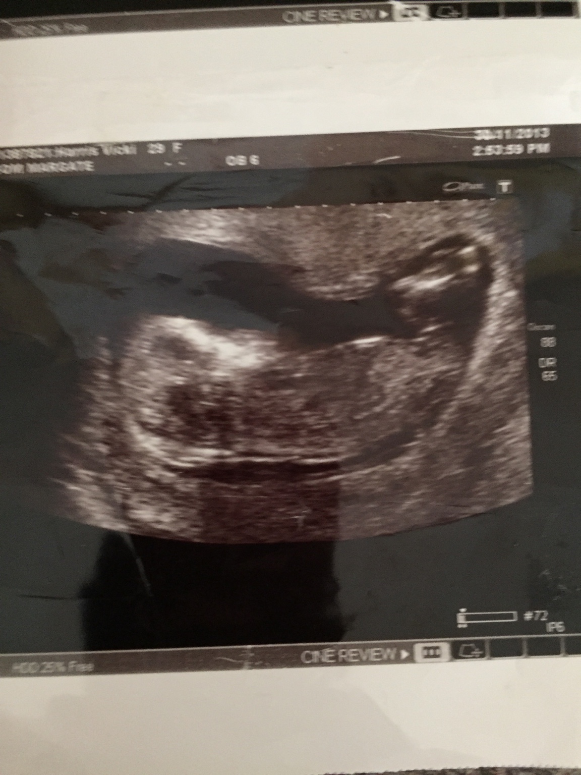 12 week scan