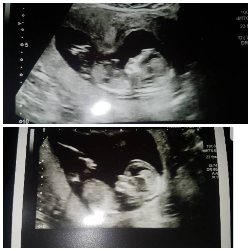 GENDER predict? 12 week scan!