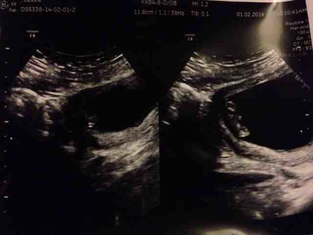 16 week scan