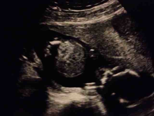 16 week scan