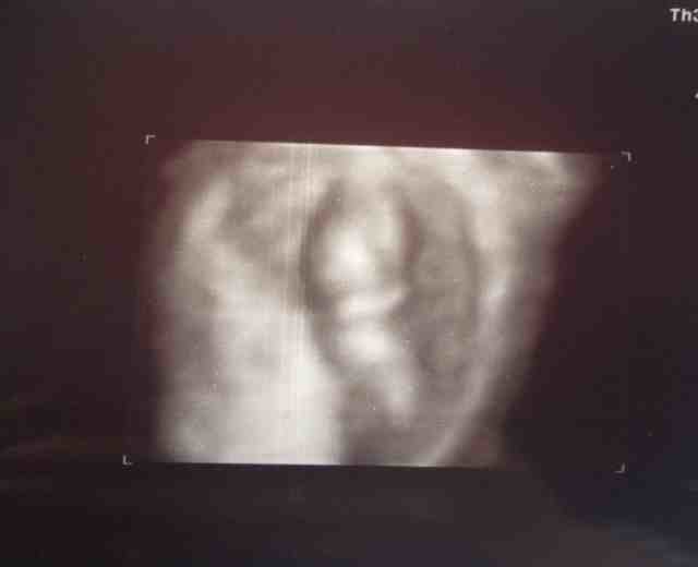 10 week scan pics.