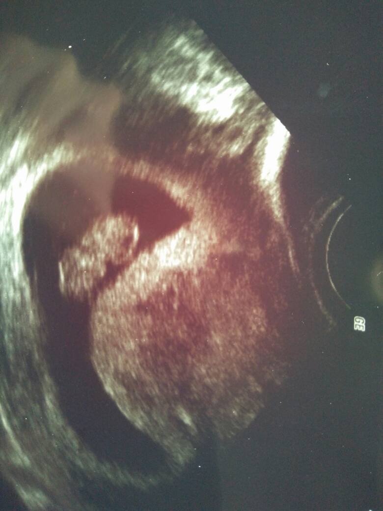 Anyone have an 8 weeks scan to show me