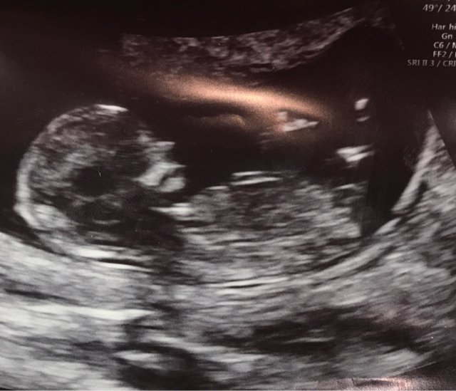 Anyone have an 8 weeks scan to show me