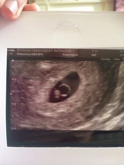 What can you see on 6 week scan?