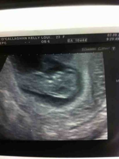 10.4 week scan pics so relieved