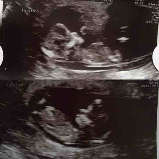 12 week scans :)