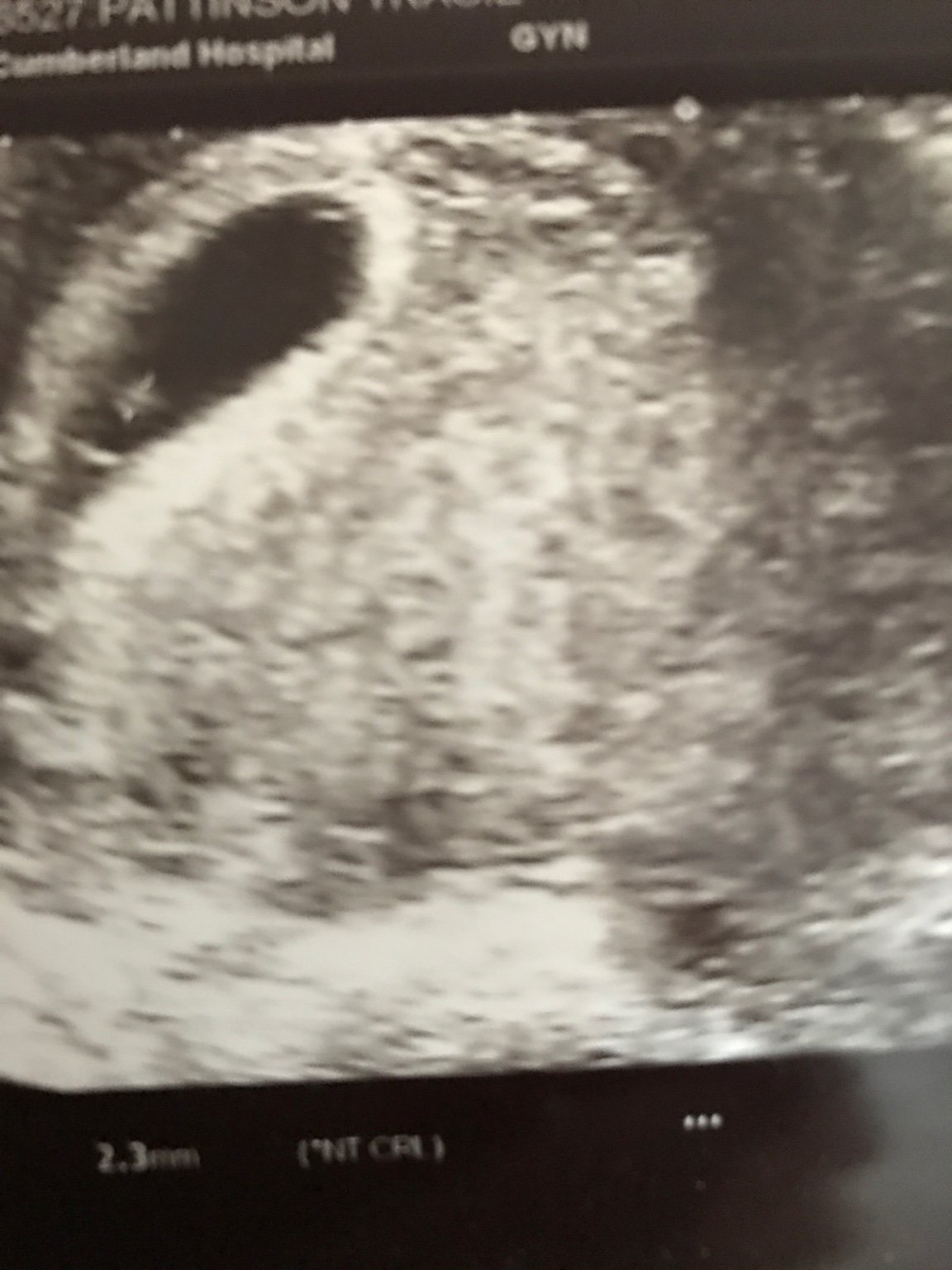 Help. 7 week scan only sac seen
